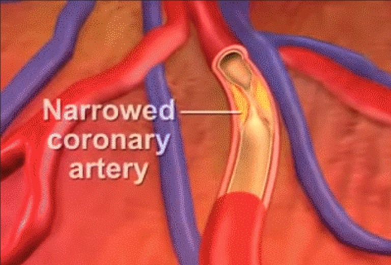 Coronary Angioplasty in Hyderabad | PCI Surgery | Angioplasty Cost ...
